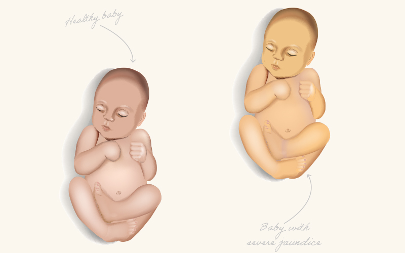 Understanding neonatal jaundice - Community Practitioner